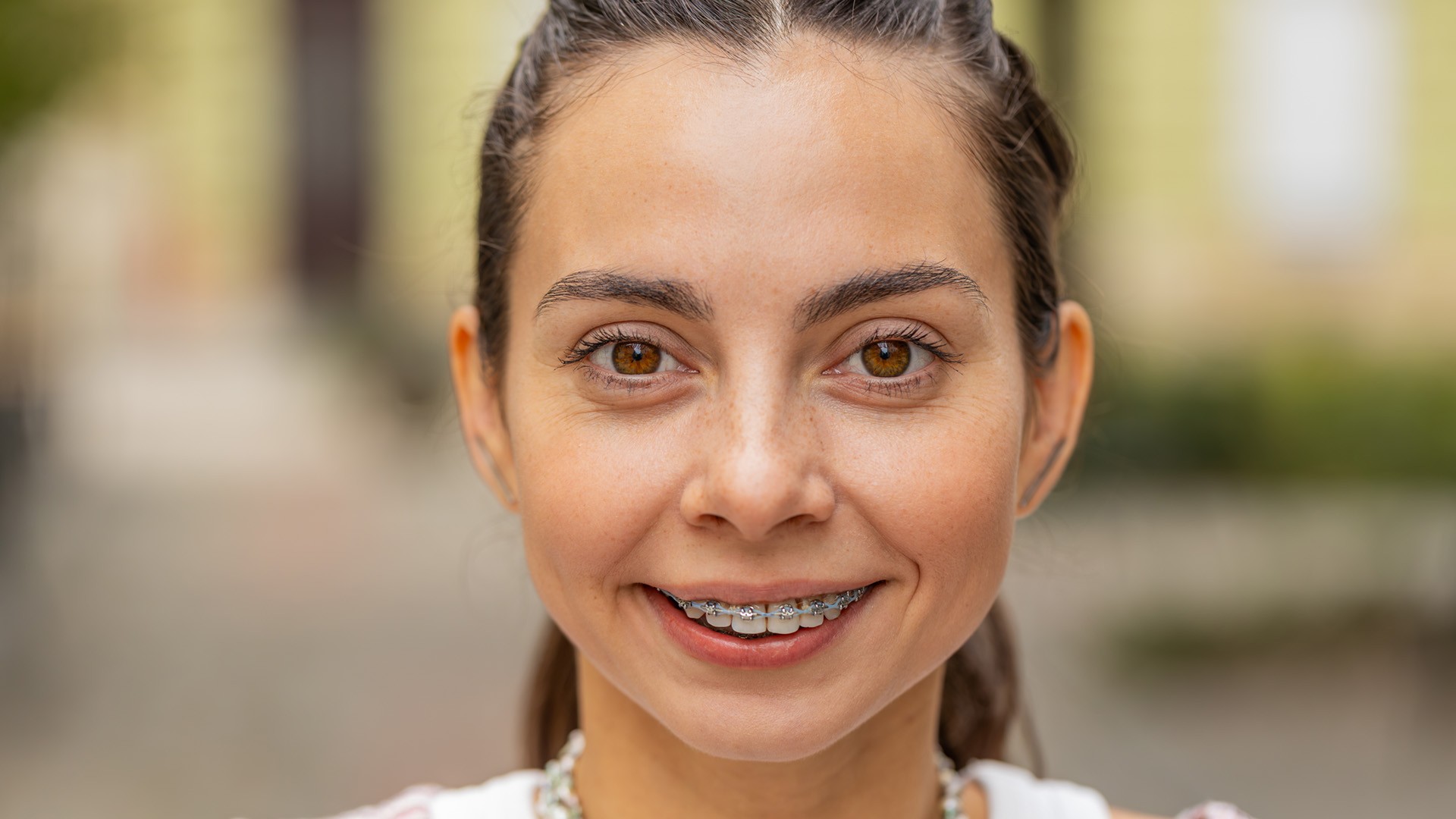 1st Day with Braces: What to Expect | Uncommon Orthodontics