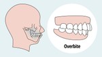 Overbite Correction Techniques | Your Complete Guide