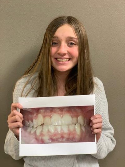 Invisalign Before & After | Uncommon Orthodontics